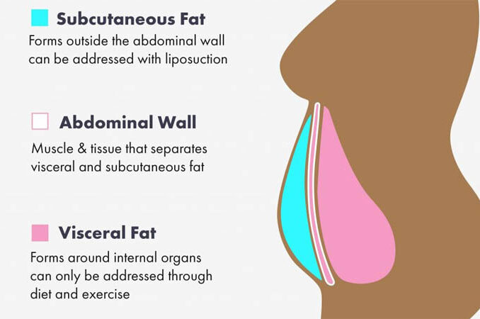 What is Belly Fat or Visceral Fat? How is Visceral Fat Different From ...