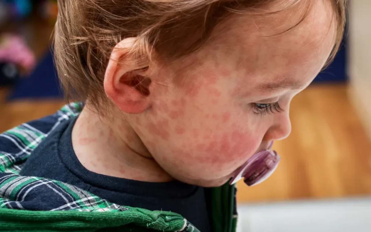 Understanding Allergies: Different Types of Allergies and Their Causes ...